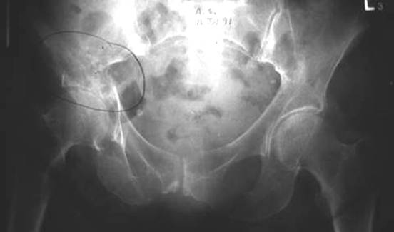 Chondrosarcoma - Pathology - Orthobullets